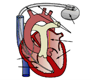 Pacemaker Electrode